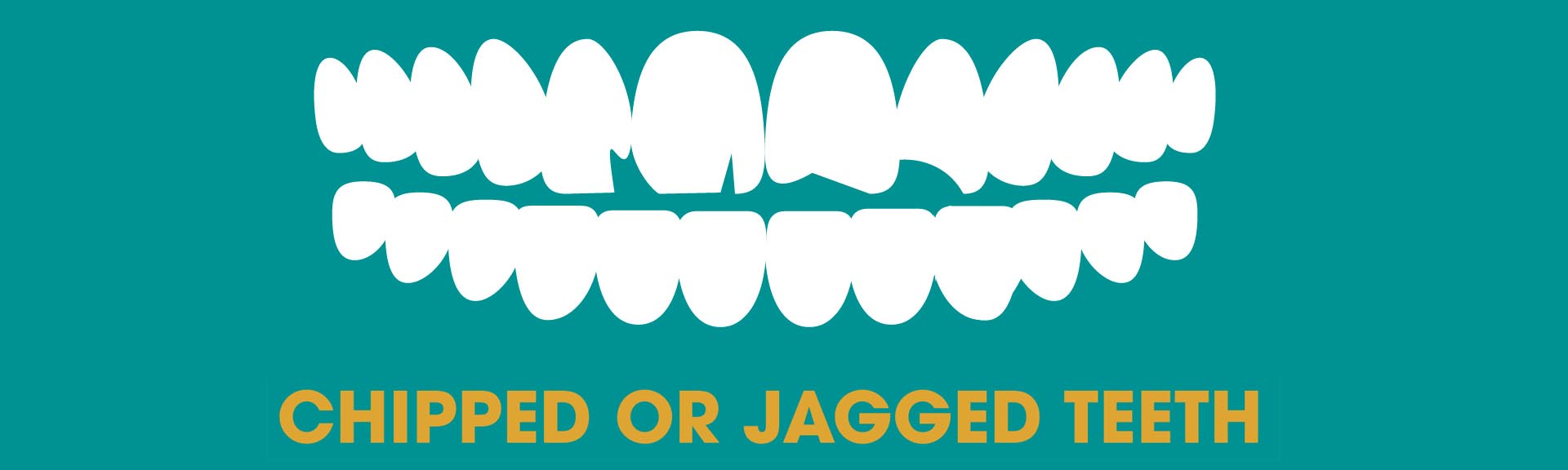 Designing Your Custom Smile with Dental Veneers - Sagewood Dental Group