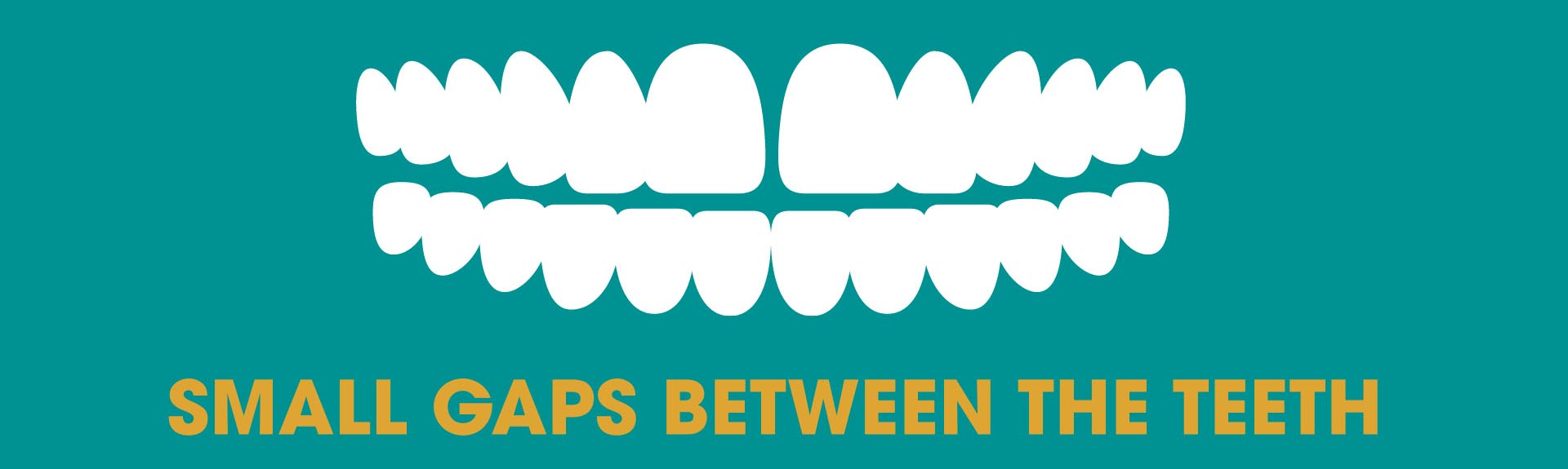 Designing Your Custom Smile with Dental Veneers - Sagewood Dental Group